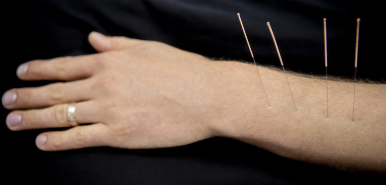 What is dry needling and how can it benefit me? - MediPhysio